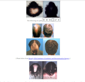 Scalp Expansion and Extensions - Regrowth. Your Source Of Hair News