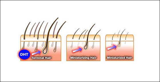 DHT 101 - Regrowth. Your Source Of Hair News